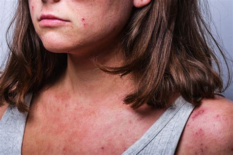 Dermatite Atopica Il Ruolo Del Farmacista Farmacia News