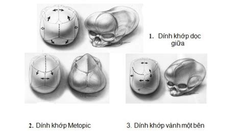 Các Loại Dính Khớp Sọ Thường Gặp ở Trẻ Em Vinmec