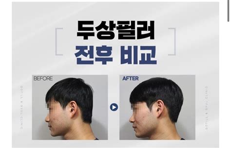 남자들이 의외로 많이하는 성형  유머 움짤 이슈 에펨코리아