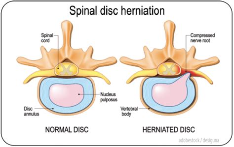 Closing The Coding Gap For Annular Defects Aapc Knowledge Center