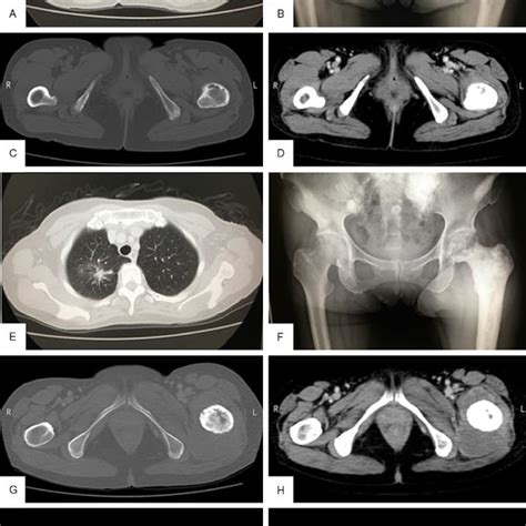 Histologies Of The Primary Lung Adenocarcinoma And Femoral Tumor A