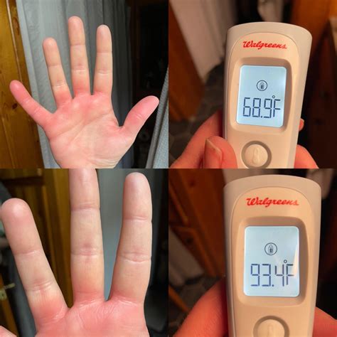 Raynauds And Em At The Same Time Rraynauds