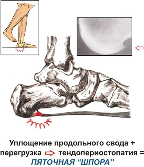 Центр здоровья ног / Пяточная шпора
