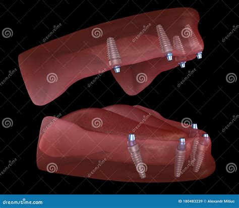 Maxillary And Mandibular Prosthesis With Gum All On 4 System Supported By Implants Medically