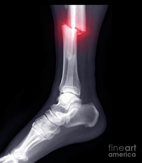 Broken Leg Bones