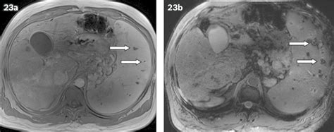 Gamna‑gandy Bodies In A 68‑year‑old Man With Liver Cirrhosis And Portal