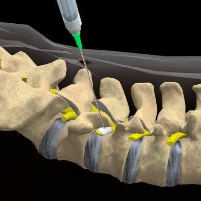Epidural Steroid Injections Wasatch Pain Solutions