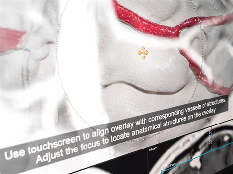 Microscope Navigation Precision For Neurosurgery Brainlab