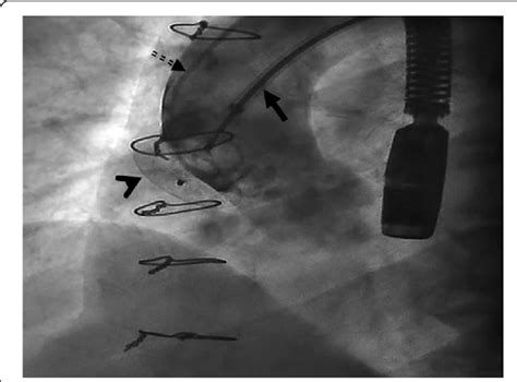 Flouroscopy During Aortic Root Injection Before Complete Release Of Asd