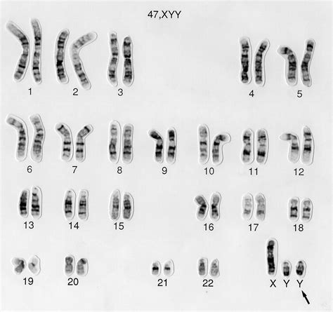 Sex Chromosome Abnormalities