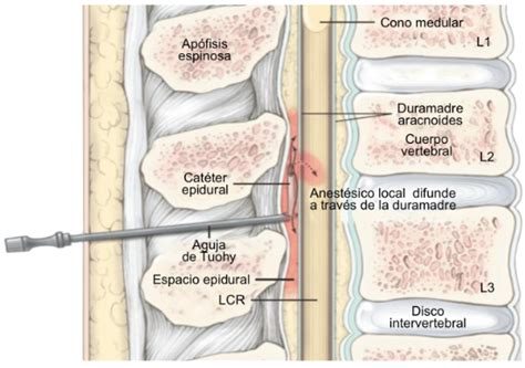 Analgesia Neuroaxial Epidural Continua Anestesiología Mexicana En