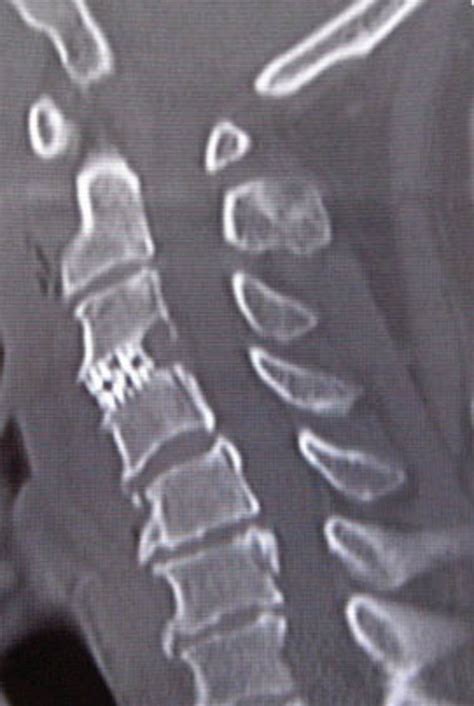 Schematic Drawings In The Sagittal View Of Anterior Cervical Discectomy