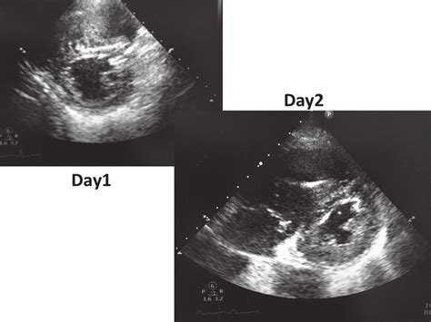 Parasternal Short Axis View At The Level Of The Papillary Muscles