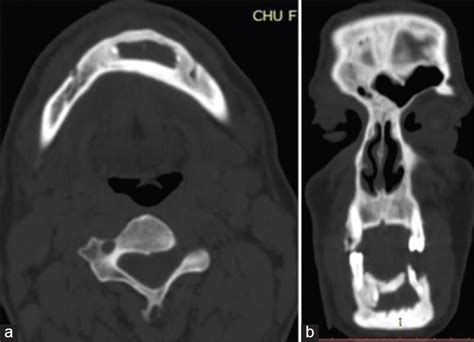 Nevoid Basal Cell Carcinoma Syndrome Gorlin Goltz Syndrome Indian