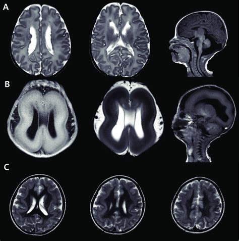Neuronal Migration Anomaly A A 1 Month Old Female Patient Showing Download Scientific