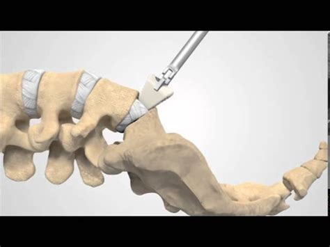 Bernard Clavecilla On Linkedin Alif Patient Animation