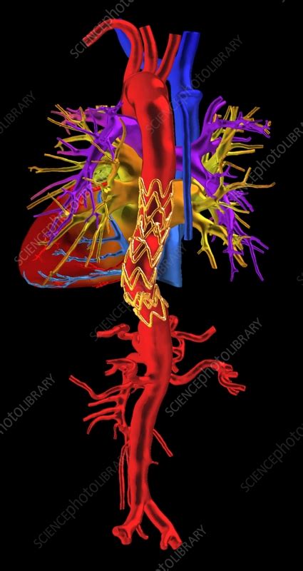 Aortic Aneurysm Stent Ct Scan Stock Image C0593697 Science