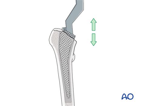 Hemiarthroplasty For Transcervical Shear Fractures Of The Femoral Neck