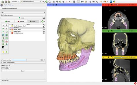 New Extension Dentalsegmentator For Automatic Dental Ct And Cbct Segmentation Support 3d