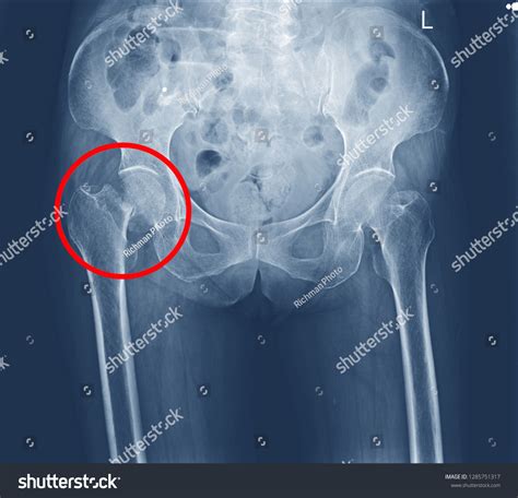 Femoral Neck Fracture