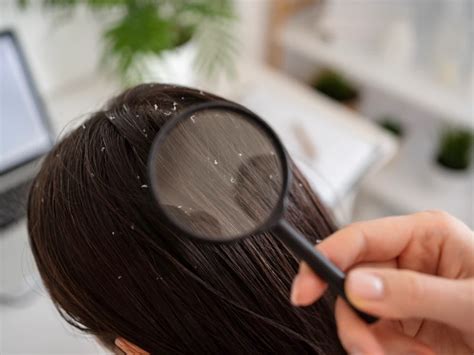 Dermatite Seborreica Dra Thâmara Morita