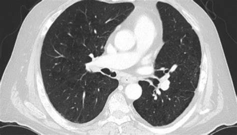 Diagnostics Of Lung Cancer Oncohema Key