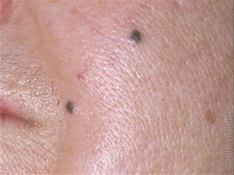 Youve Seen Rashes And Called Them All Maculopapular Because Why