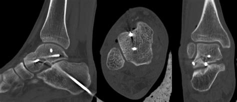 Subtalar Dislocation The Foot And Ankle Online Journal
