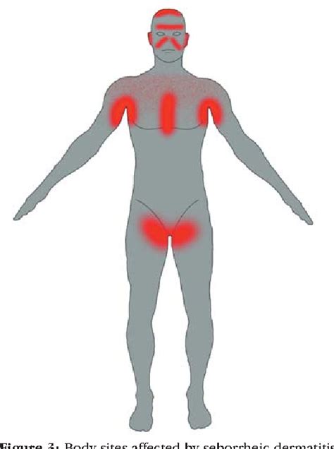 Medical For Us Seborrheic Dermatitis And Dandruff