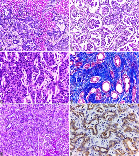 Histological And Immunohistochemical Aspects Of Cholangiocarcinoma In Download Scientific