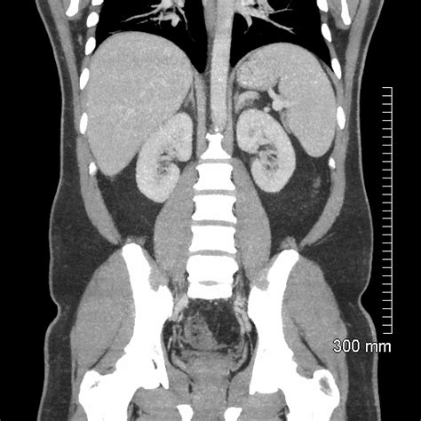 If Ct Nephrogram Phase The Common Vein