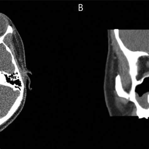 Axial And Coronal Cut Of Paranasal Sinus Ct Scan Shows Evidence Of
