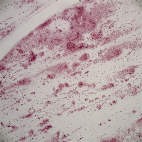 Pathology Outlines Meningioma