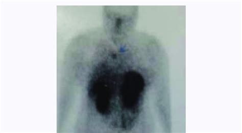 Octreotide Scan Which Showed Pathological Uptake In The Right Side Area
