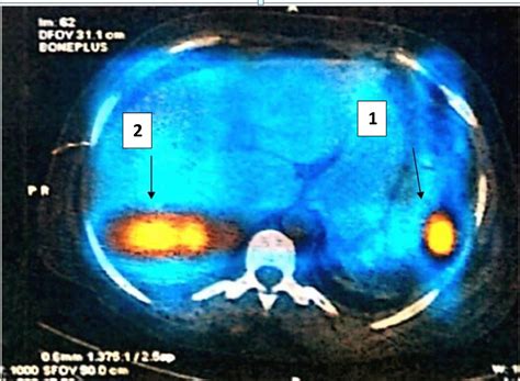 Refractory Immune Thrombocytopenic Purpura Itp After Accessory