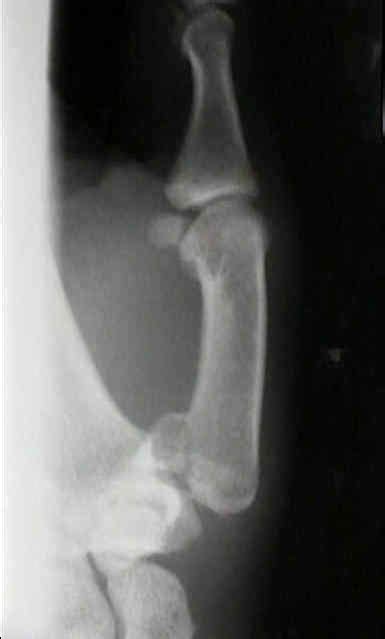 Bennetts Fracture Dislocation Wheeless Textbook Of Orthopaedics