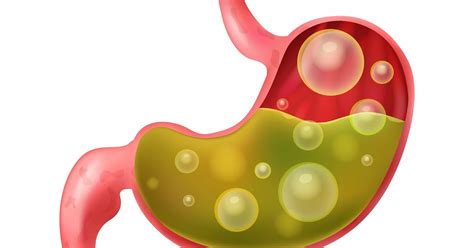 Acidity Reason Tablet Ayurvedic Home Remedy