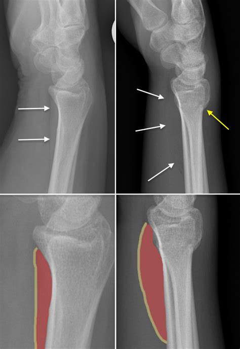 Pronator Quadratus Fat Pad Sign Radiology At St Vincents University