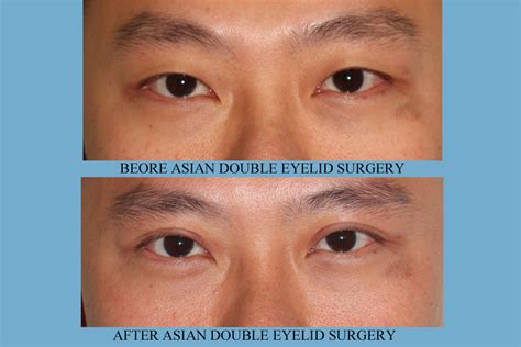 Blepharoplasty Pittsburgh Best Eyelid Surgery In 58 Off
