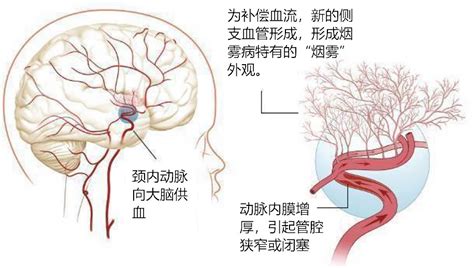 烟雾病suzuki分期——临床价值 脑医汇