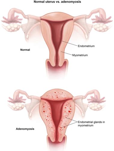 Abnormal Uterine Bleeding Flashcards Quizlet