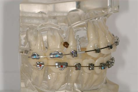 8 Ormco Vector Images At