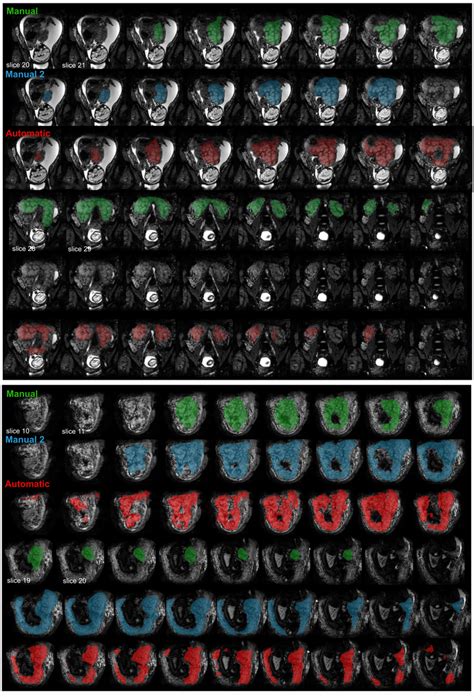 Segmentations From Both Manual Green And Automatic Red Process For