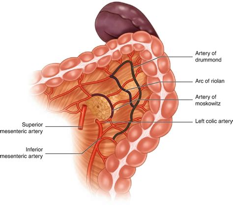Program Colorectal Pathway Laparoscopic Splenic Flexure Release Tips And Tricks Abdominal Key