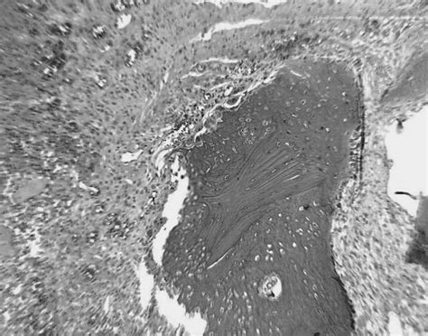 A Light Micrograph Shows A Piece Of Bone Undergoing Osteoclastic