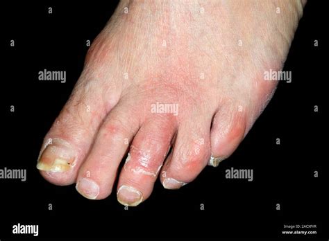 Inflammation Of The Toes And Foot Caused By Cellulitis Secondary To