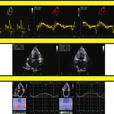 Usefulness Of Adding Left Atrial Strain To Maximal Left Atrial Volume