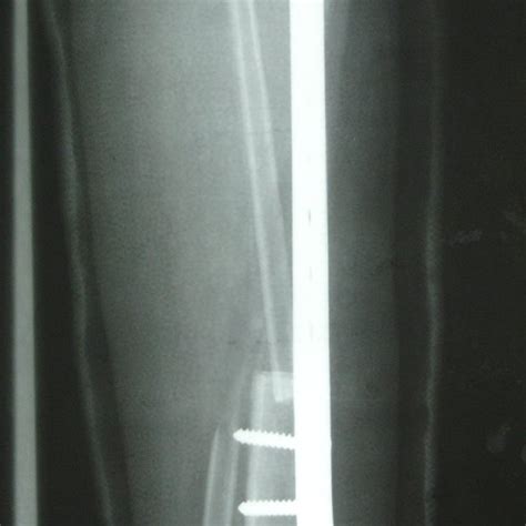 Lateral View With Marked Procurvatum Deformity Download Scientific