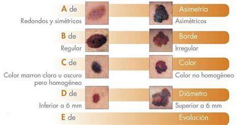 Diferencias Entre Lunares Malignos Y Benignos