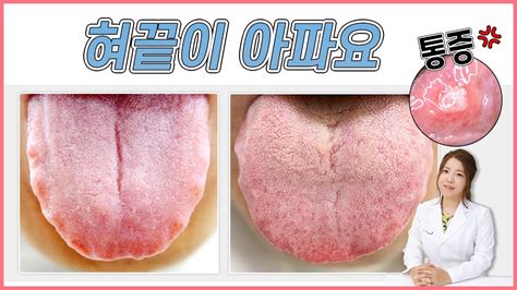 혀끝이 아파요 혀끝 통증 3가지 원인 구내염 치흔 구강작열감증후군 Youtube